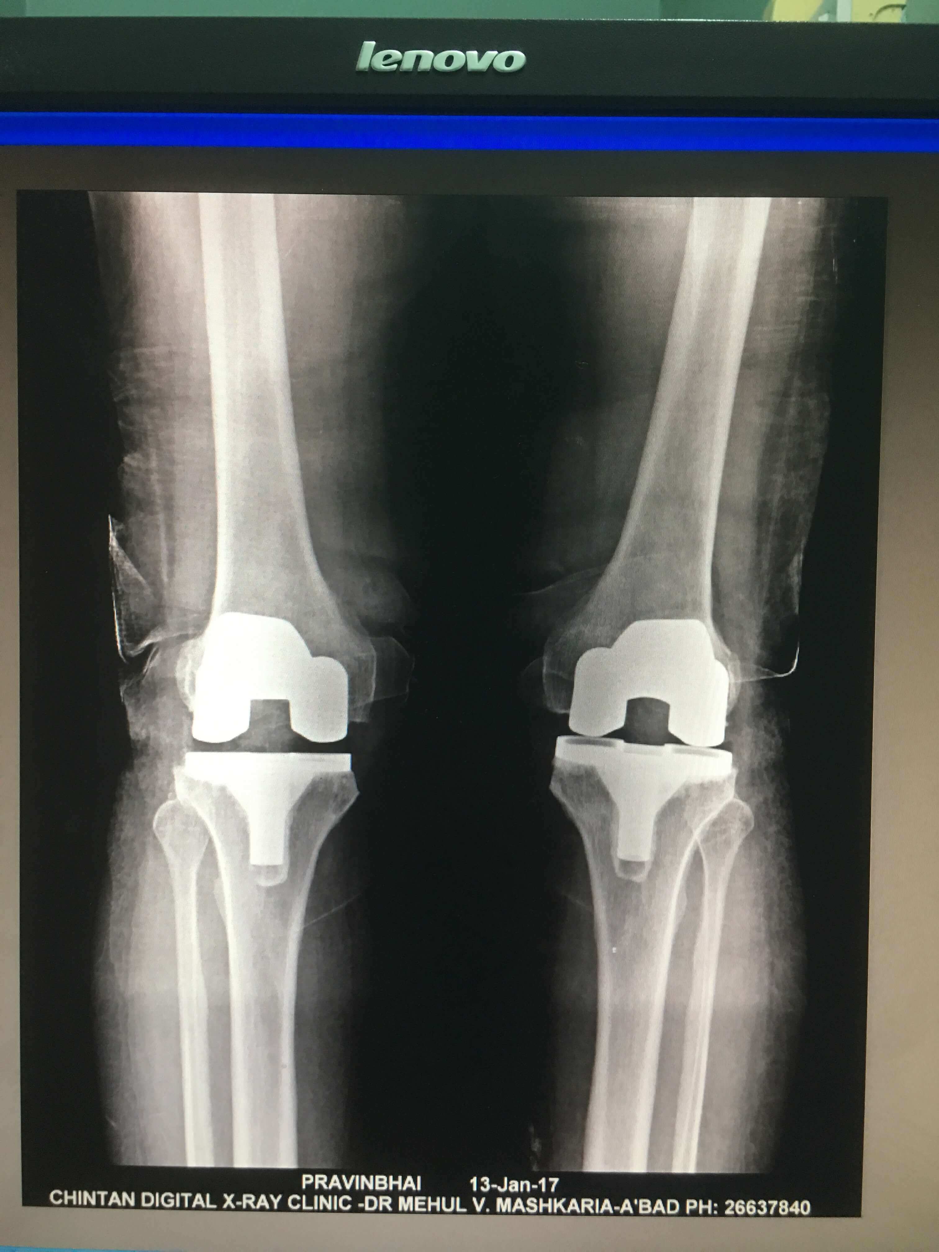Total Knee Replacement in Ahmedabad, Gujarat, Jivraj Park, Satellite