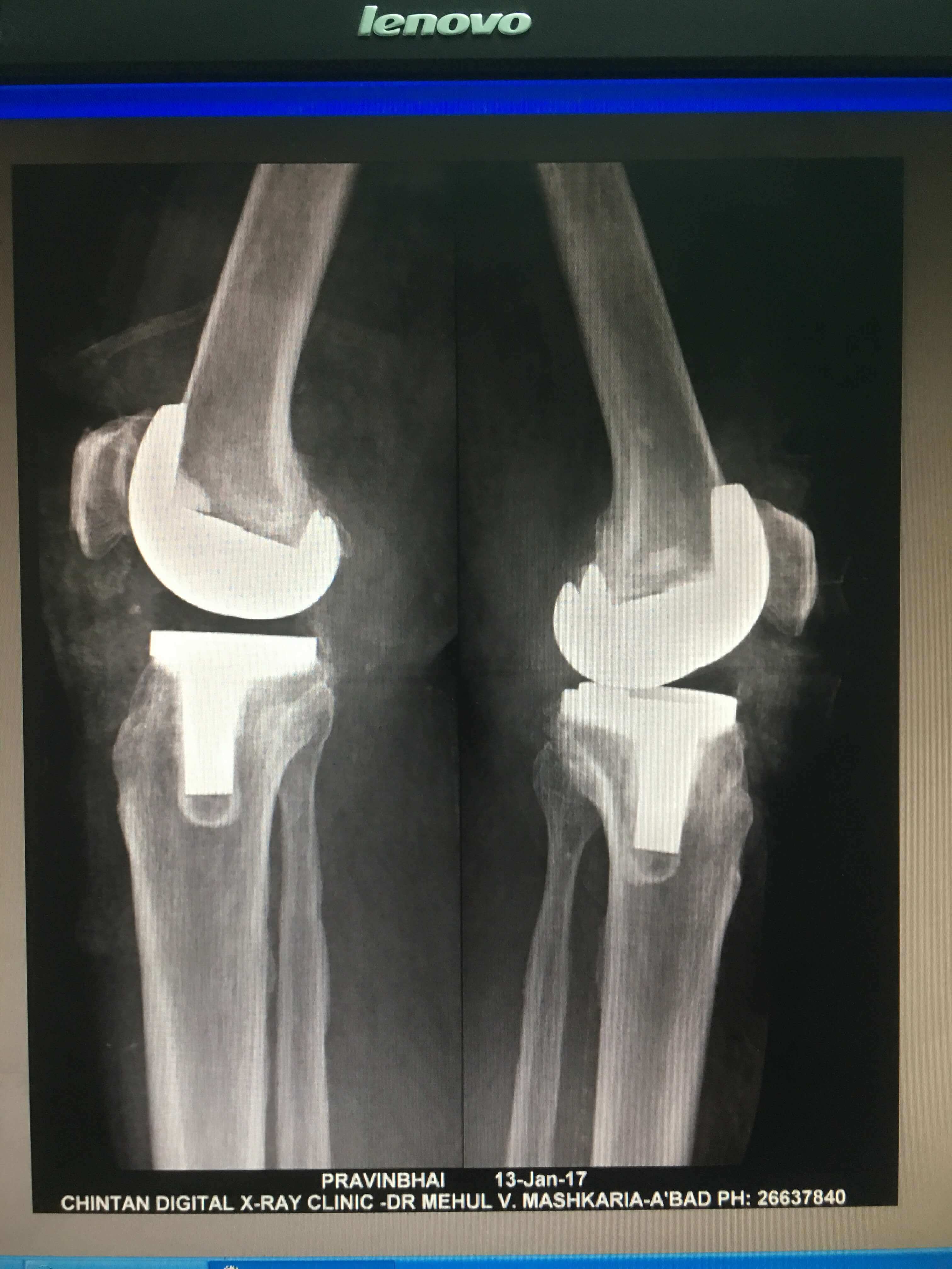 Total Knee Replacement in Ahmedabad, Gujarat, Jivraj Park, Satellite